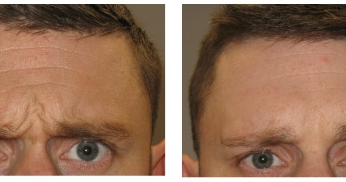 Male Botox | Woodford Medical