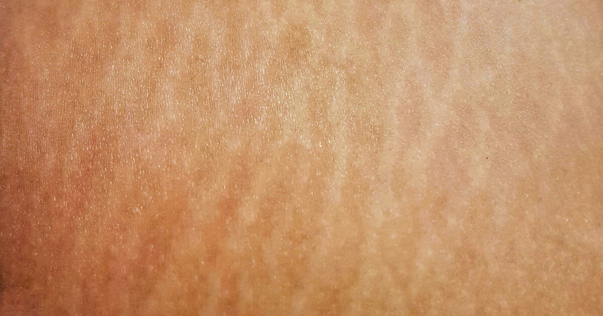 Poor Skin Quality, Scars And Stretchmarks | Woodford Medical