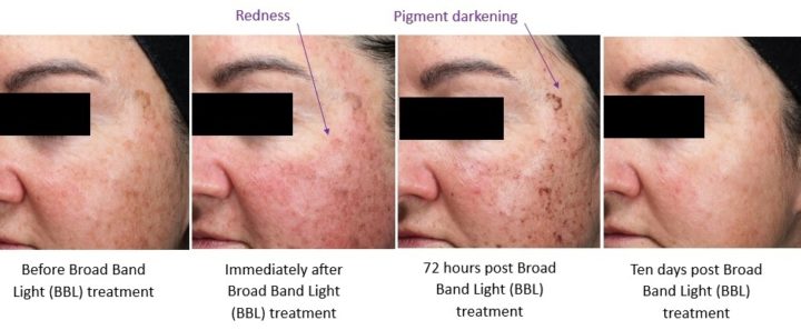 Sciton BBL Broad Band Light Laser Side Effects | Woodford Medical