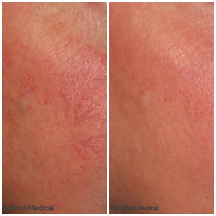 Facial Redness & Rosacea | Woodford Medical