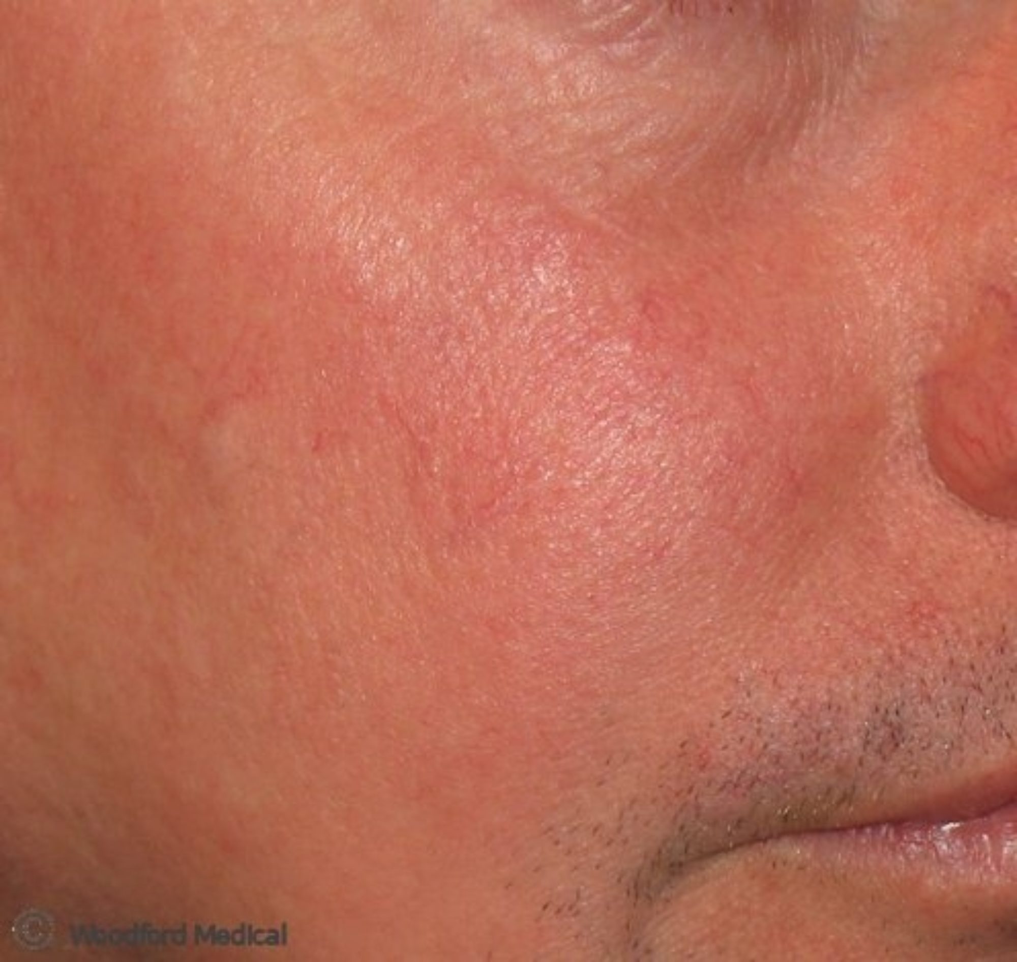 Facial Redness, Rosacea And Blushing | Woodford Medical